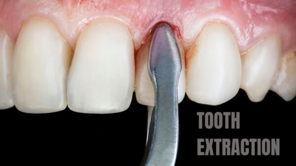 Understanding Tooth Extraction: Everything You Need to Know